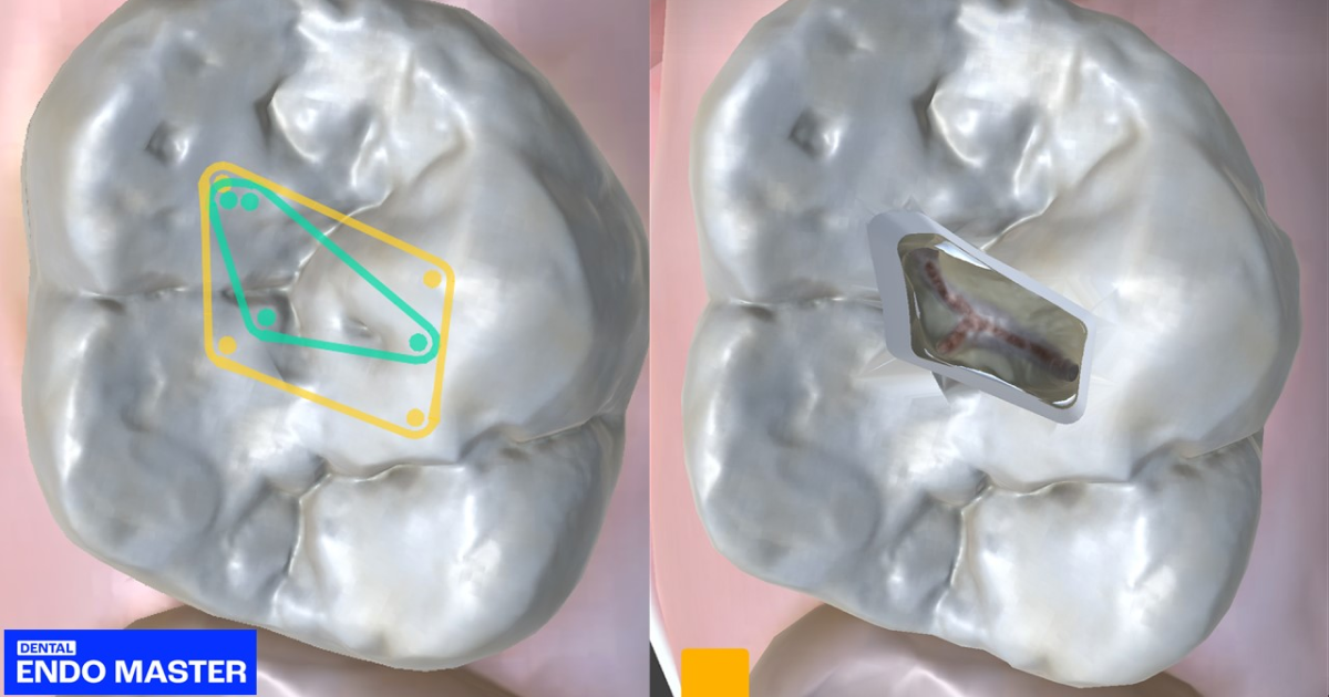 The Story Behind Dental EndoMaster - Dental Master Series